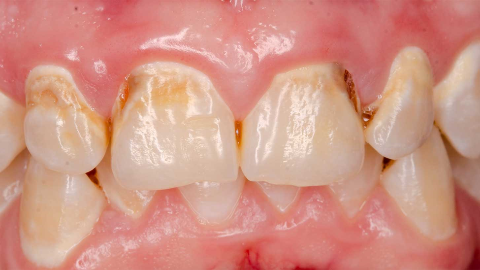 E-cigarettes and Oral Health: Is Vaping a Safer Alternative to Smoking?