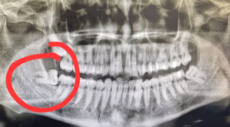 Why Do Wisdom Teeth Grow Sideways?